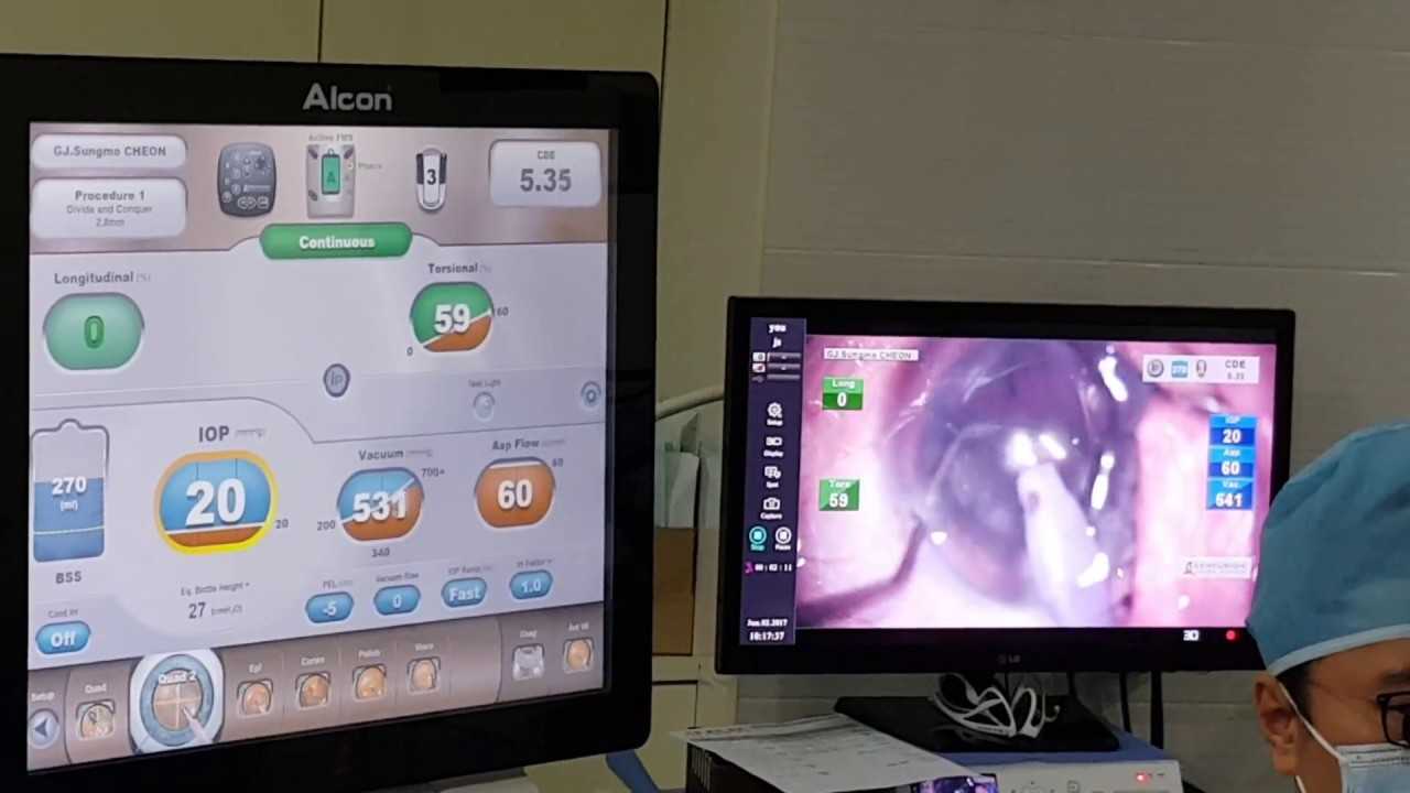 Alcon Centurion Phaco Vision System | Saturn Optical