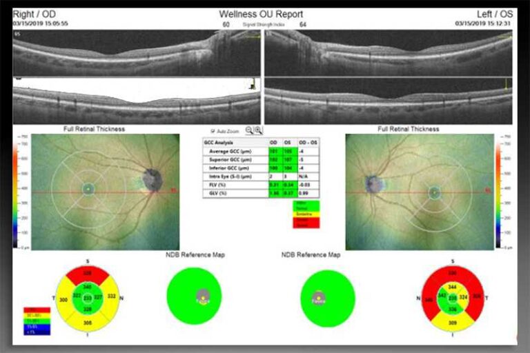 Optovue Solix OCT Angiography | Saturn Optical