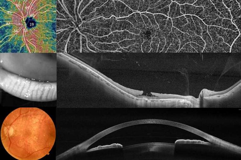 Optovue Solix OCT Angiography | Saturn Optical