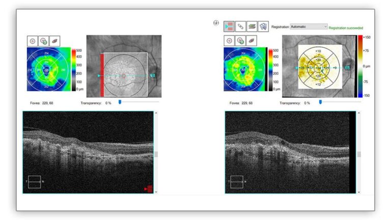Zeiss CIRRUS 6000 Advancing OCT | Saturn Optical